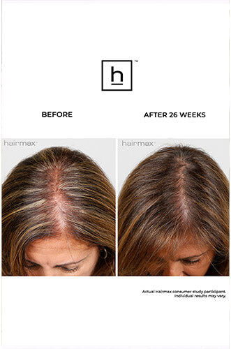 Hairmax LaserBand 82 ComfortFlex Hair Growth Device | SalonCentric