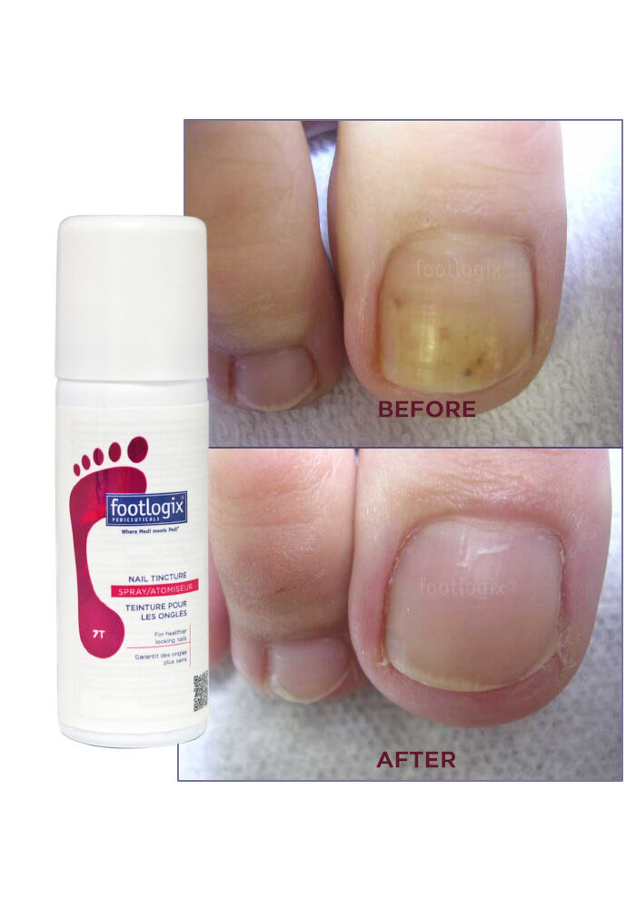 Footlogix Anti-Fungal Toe Tincture Spray | SalonCentric