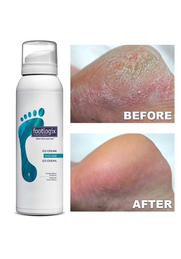 Footlogix DD Double Defense Cream Mousse | SalonCentric